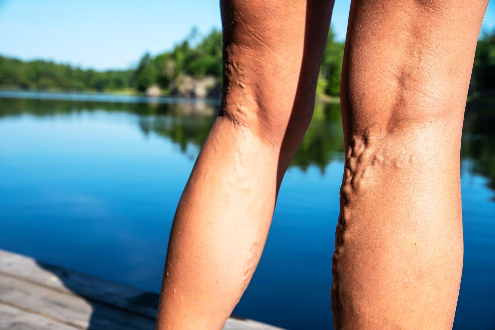 Bulging Veins: Key Causes, Symptoms, and Treatment Options
